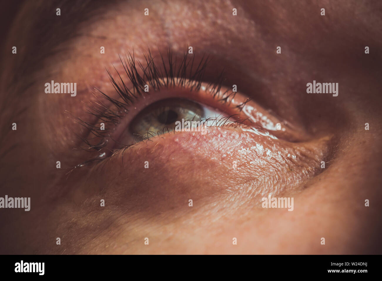 a man drips open human eye with bright red arteries drops to improve ...