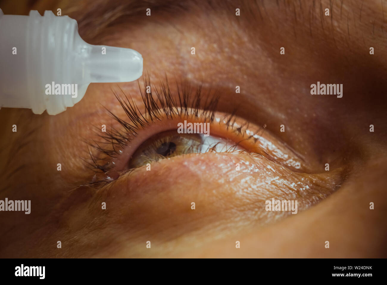a man drips open human eye with bright red arteries drops to improve ...