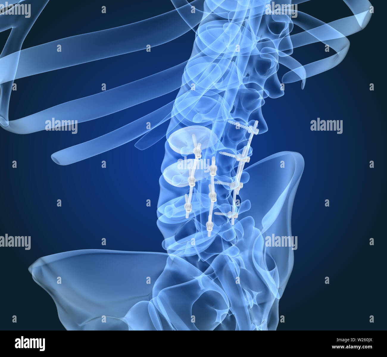 Spinal fixation system - titanium bracket. X-Ray 3D illustration Stock ...
