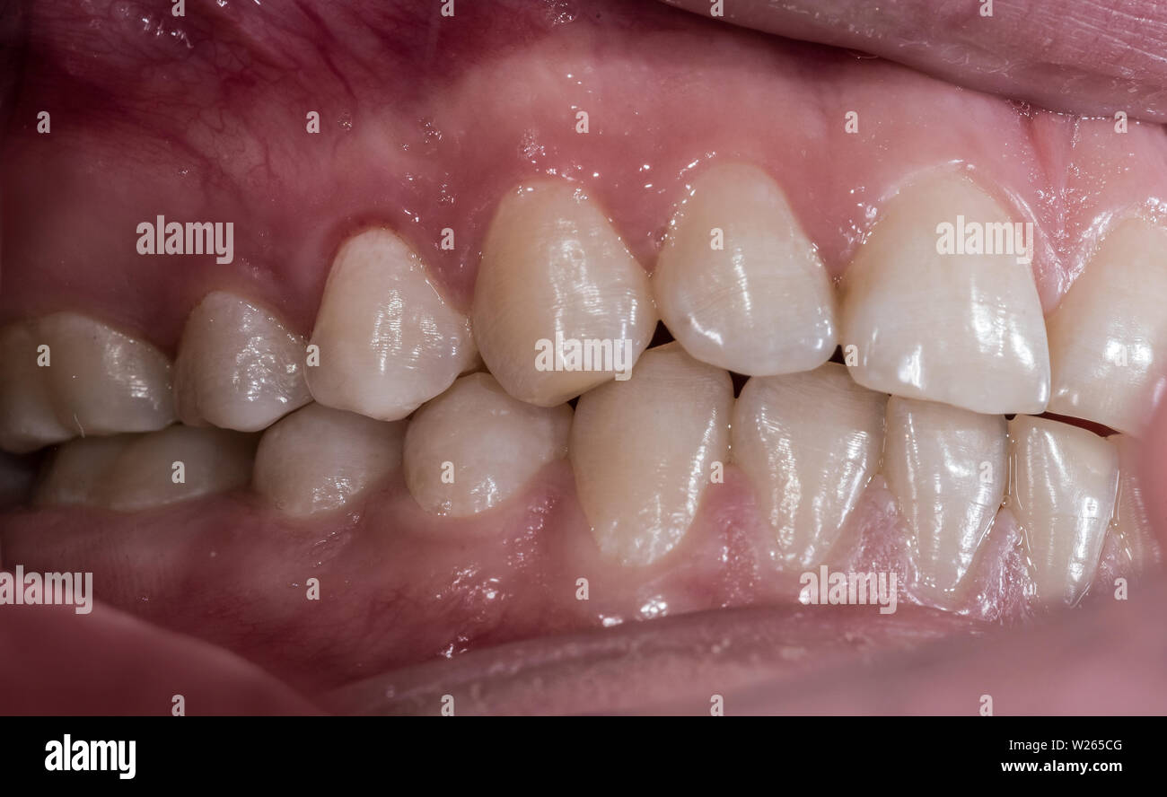 Healthy human teeth with normal occlusion from side view Stock Photo ...