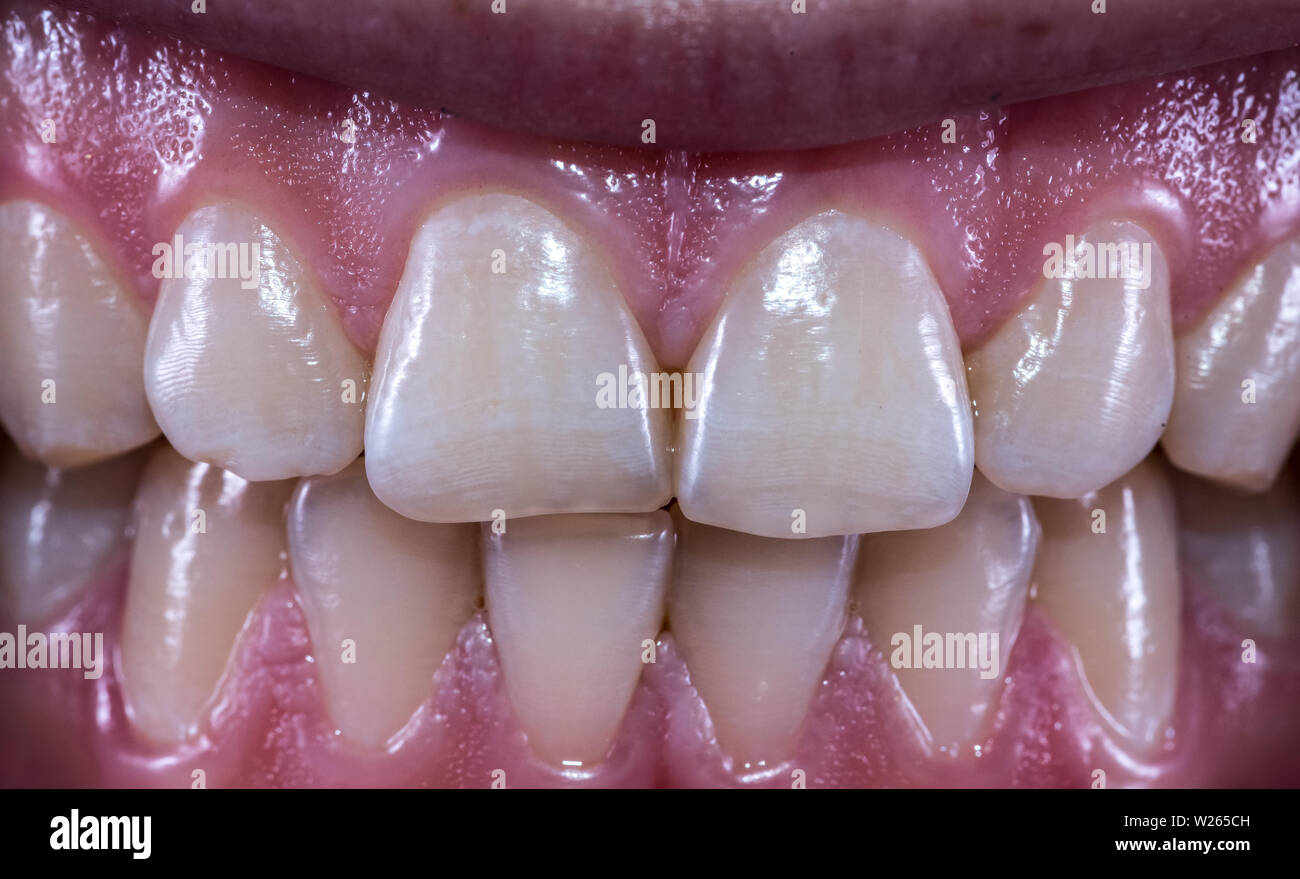Healthy human teeth with normal occlusion from frontal view Stock Photo ...