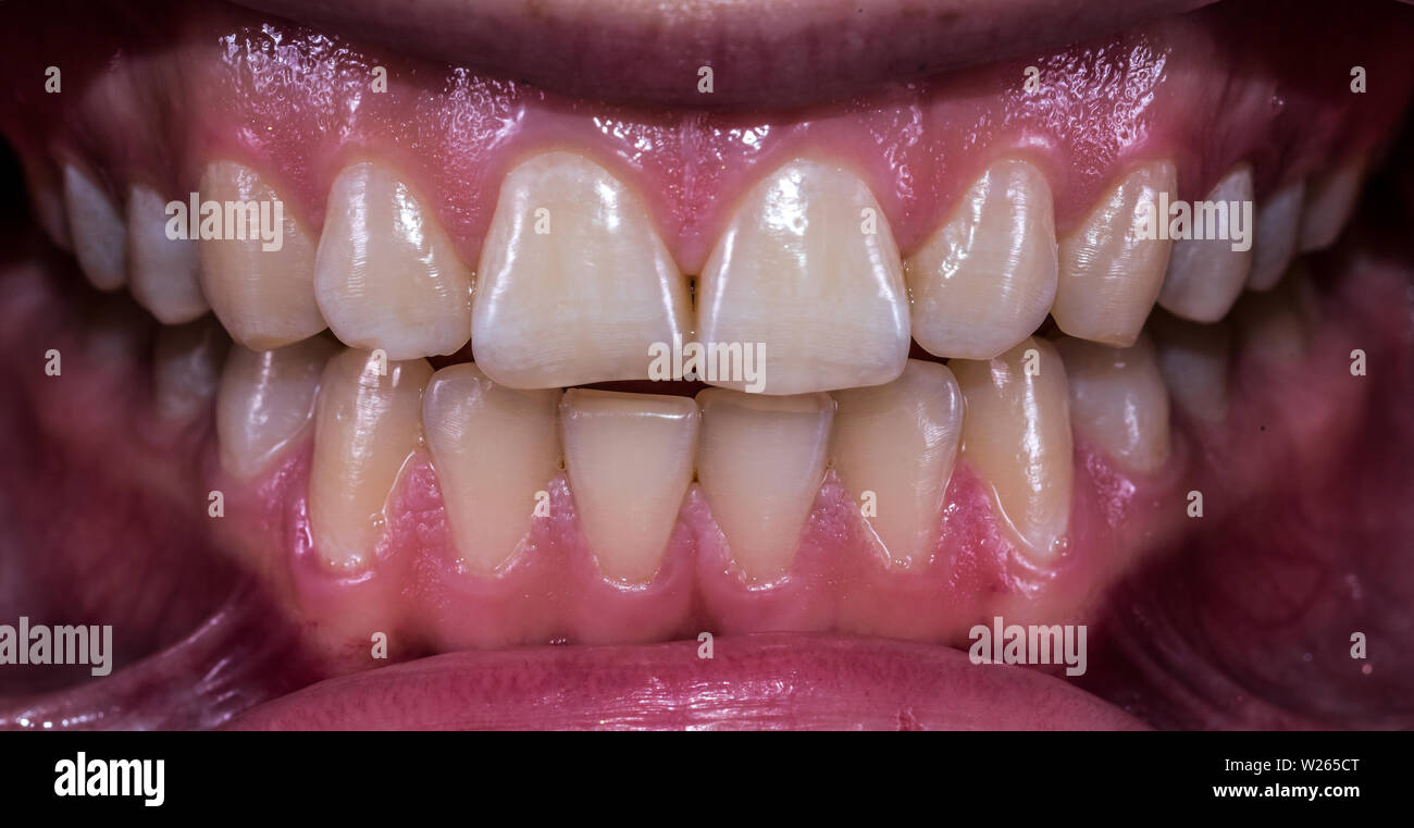 Healthy human teeth with normal occlusion from frontal view Stock Photo ...