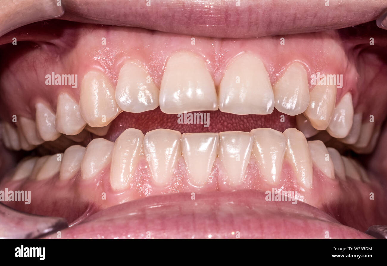 Normal Human Canine Teeth