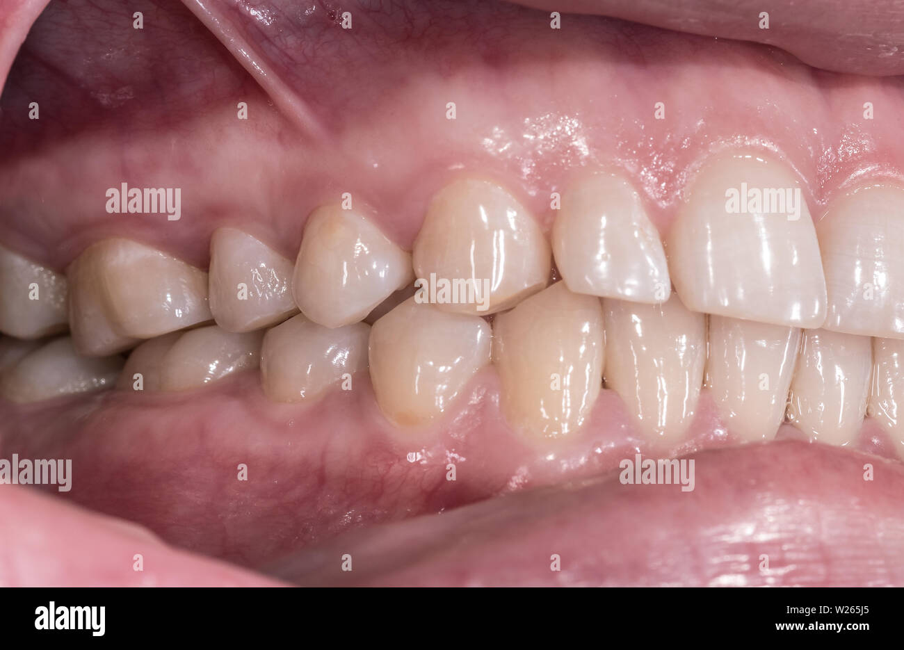 Healthy human teeth with normal occlusion from side view Stock Photo ...