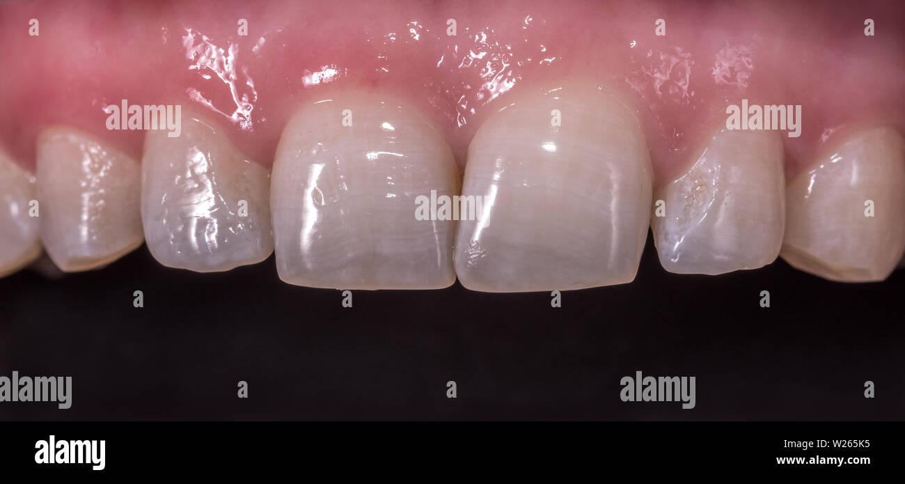 Healthy human teeth maxillary - frontal close up view Stock Photo - Alamy