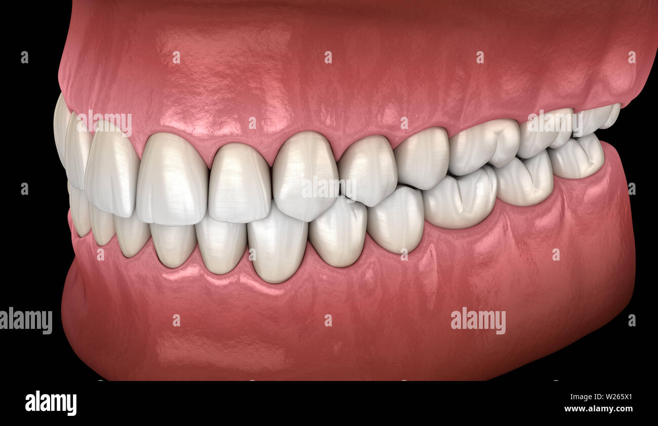 Healthy human teeth with normal occlusion, side view. Medically ...