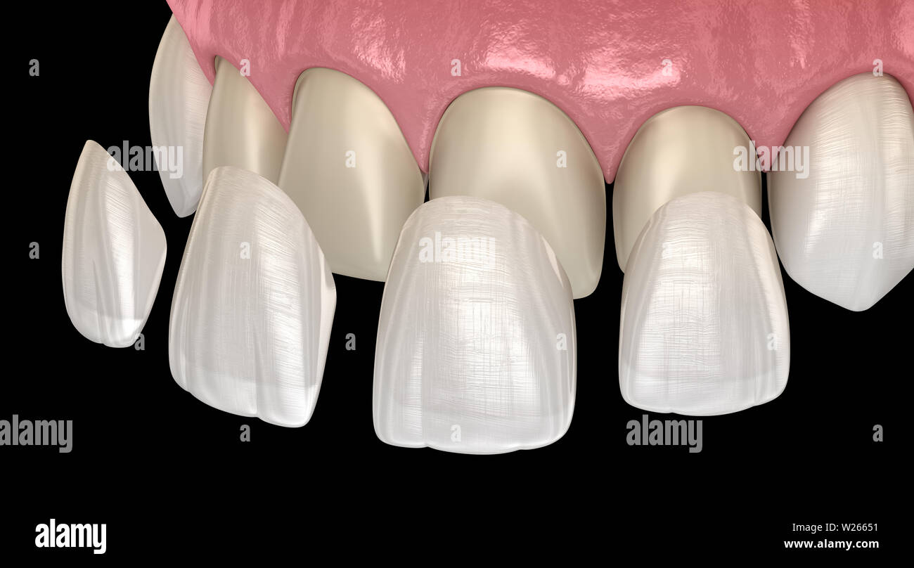 Lateral View Of Teeth