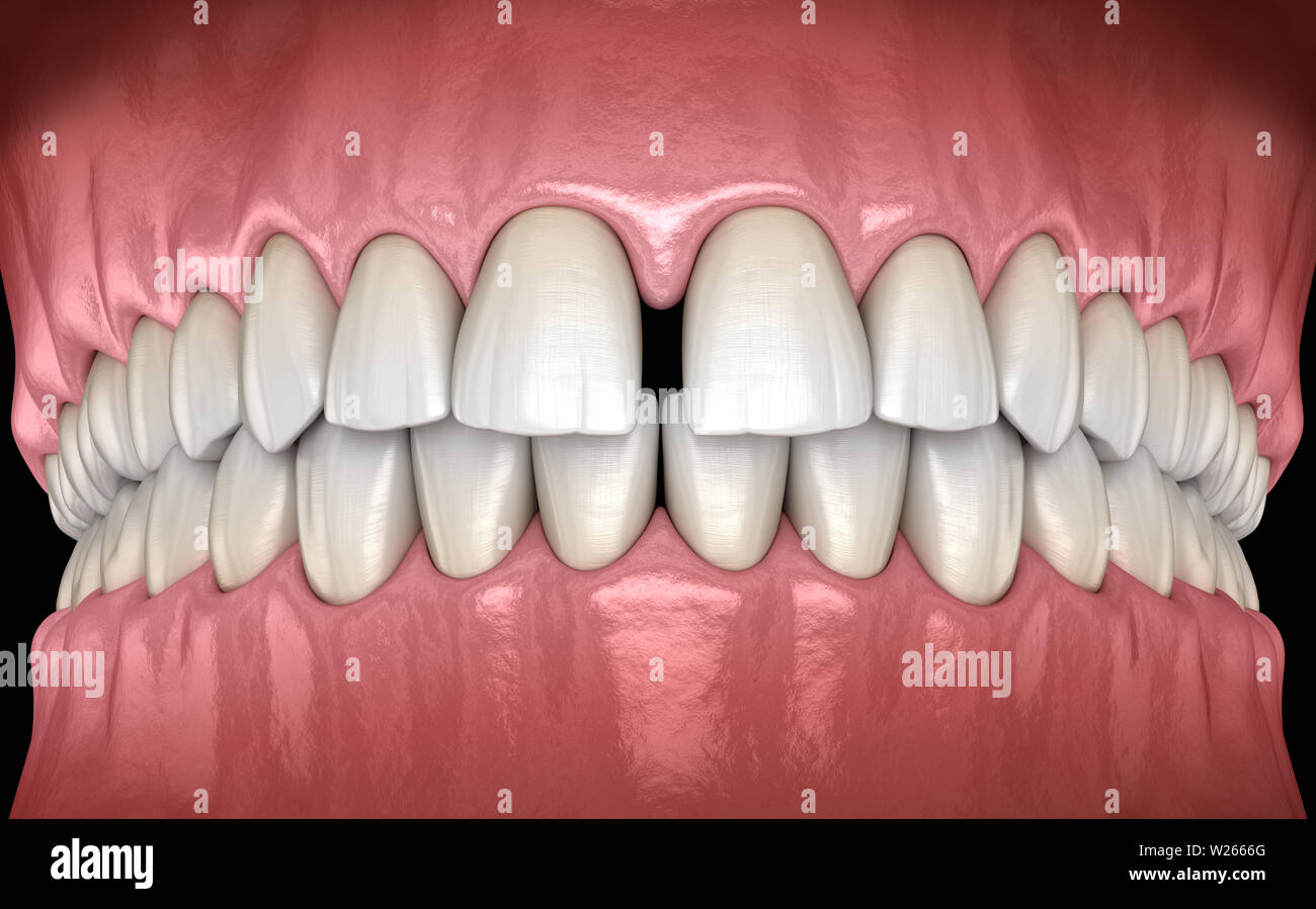 Diastema Stock Photos & Diastema Stock Images - Alamy
