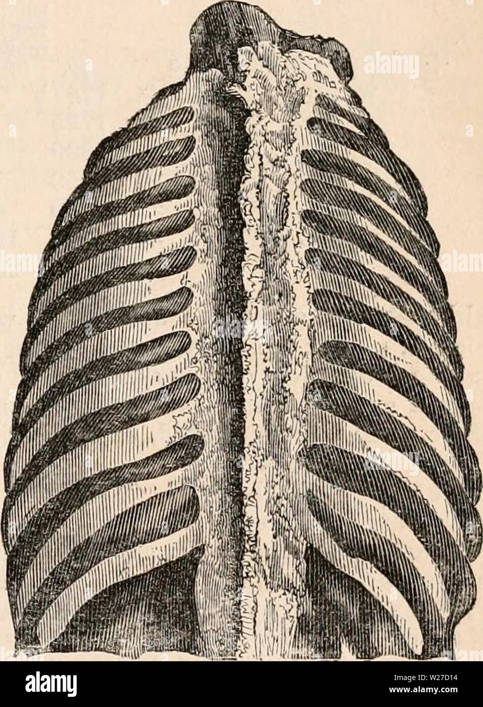 Insufflated abdomen hi-res stock photography and images - Alamy