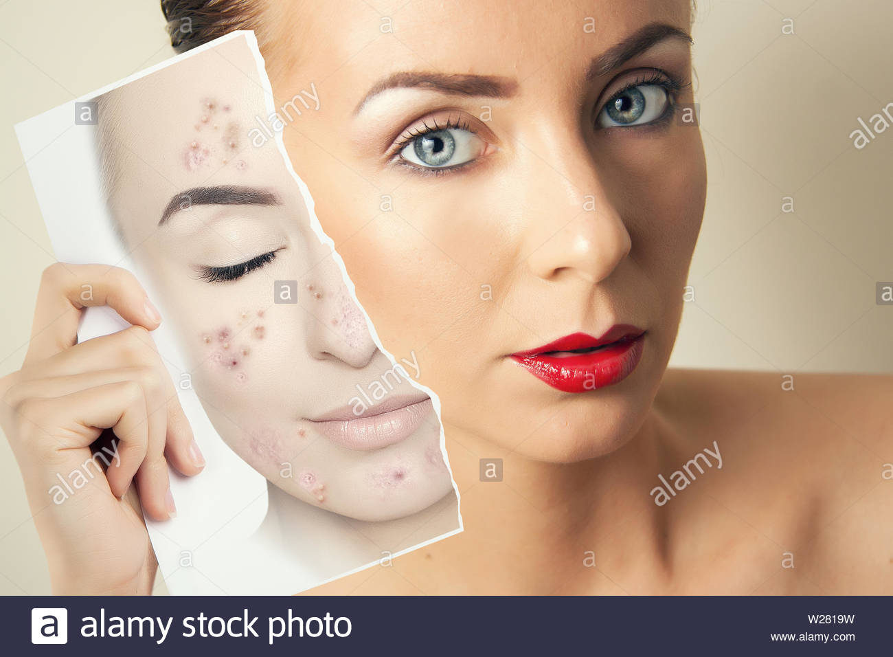 Skin Blemishes High Resolution Stock Photography and Images - Alamy