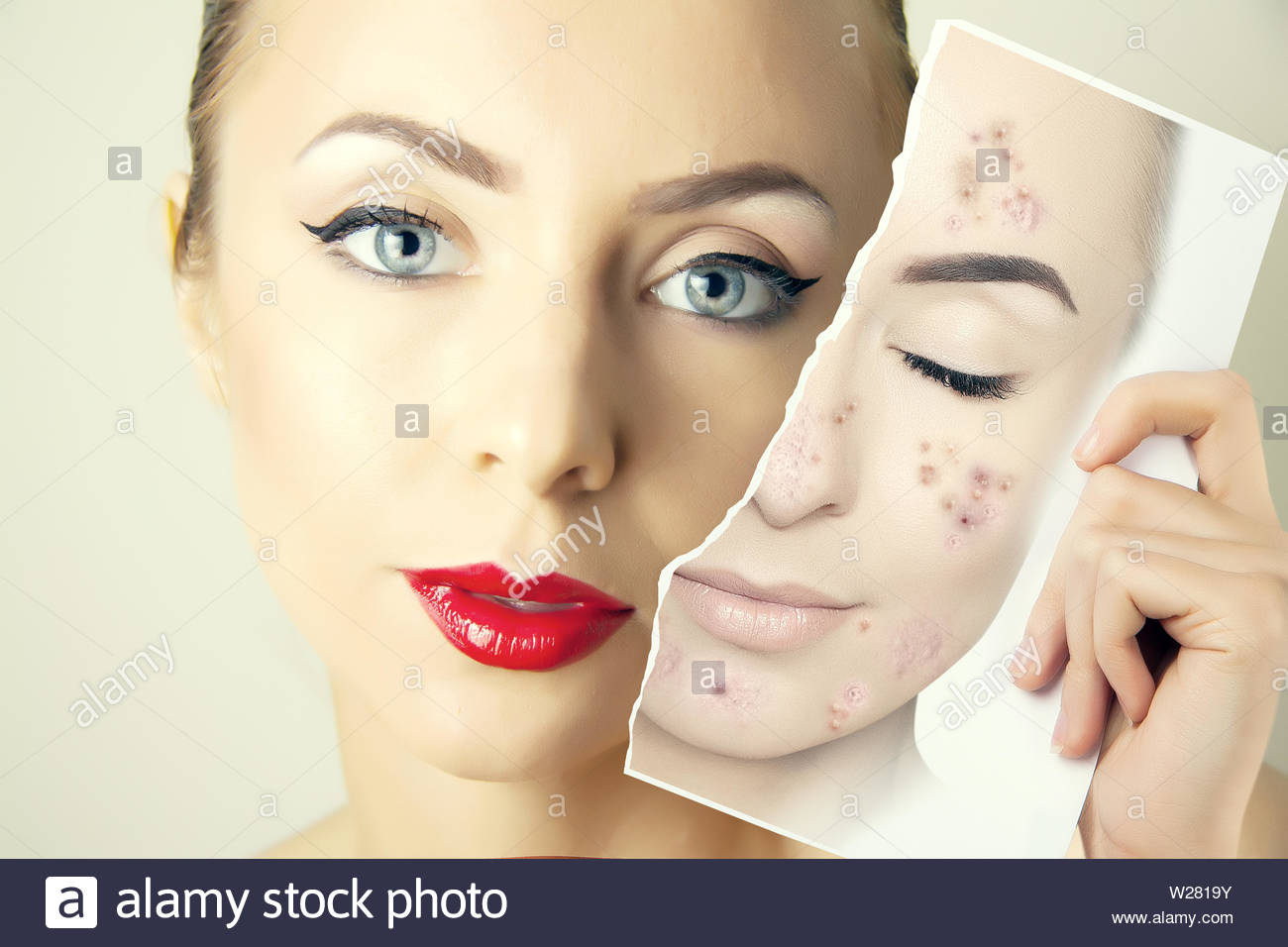 Skin Blemishes High Resolution Stock Photography and Images - Alamy