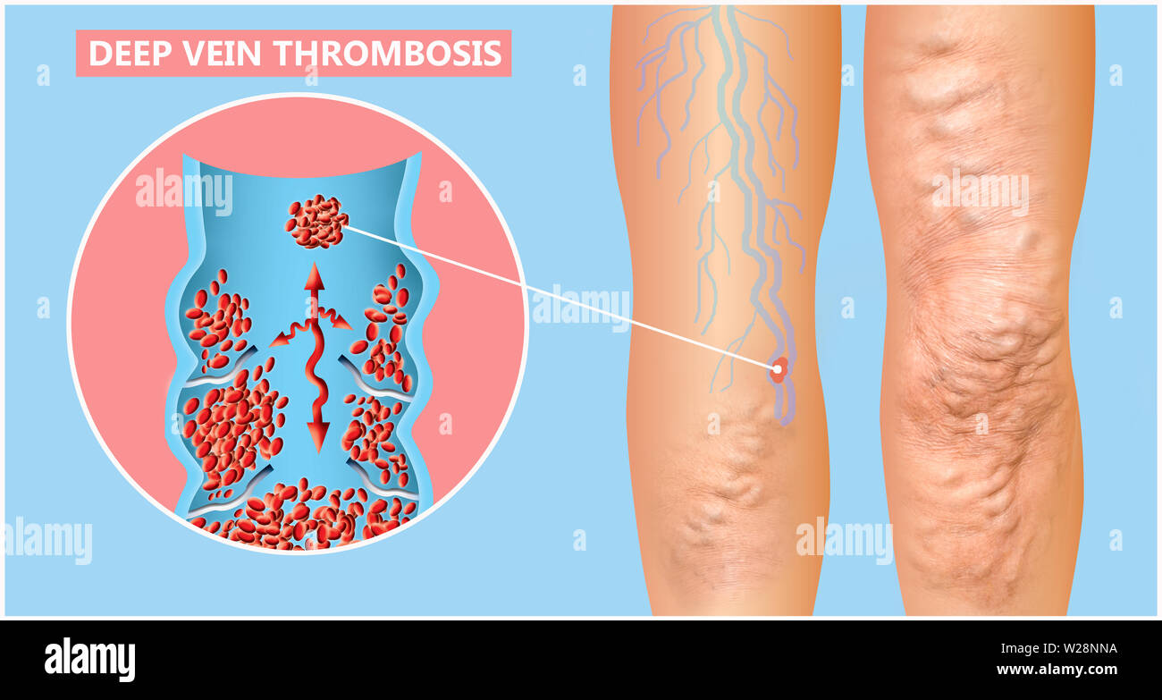 Deep Vein Thrombosis or Blood Clots. Embolus. Structure of normal and ...