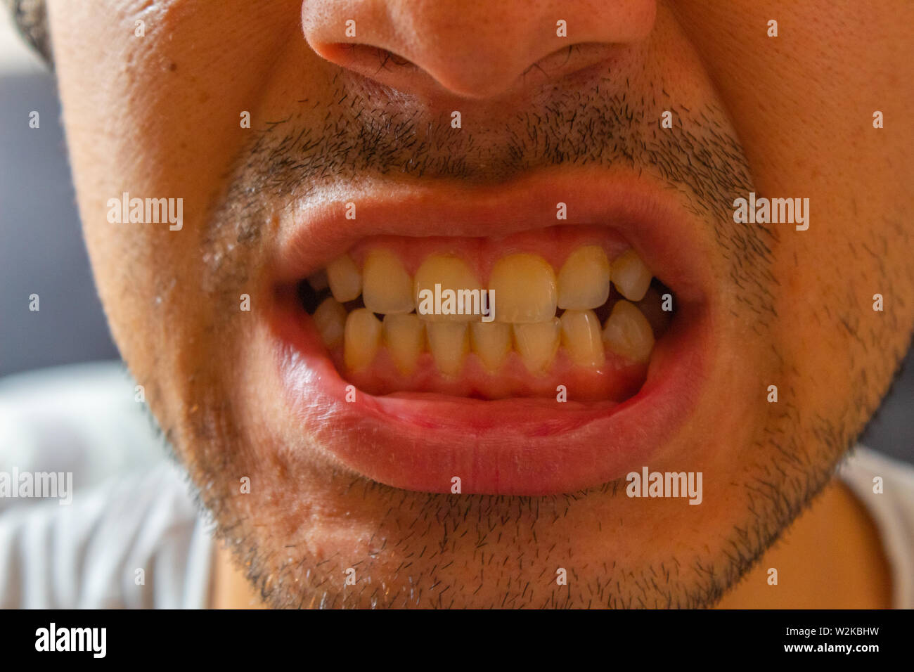 Scrappy Teeth Before And After