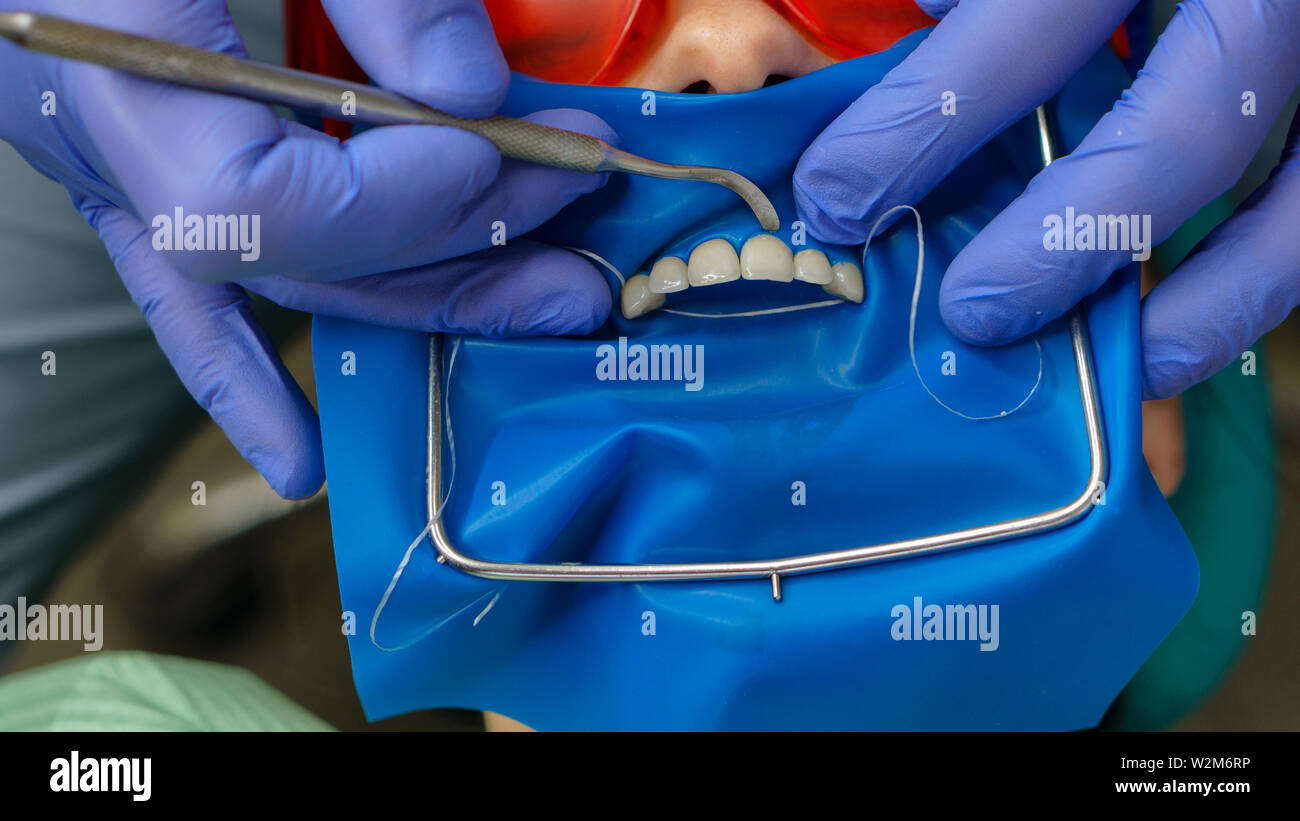 Dentist makes inspection of girl patient. Dental treatment. Dental ...