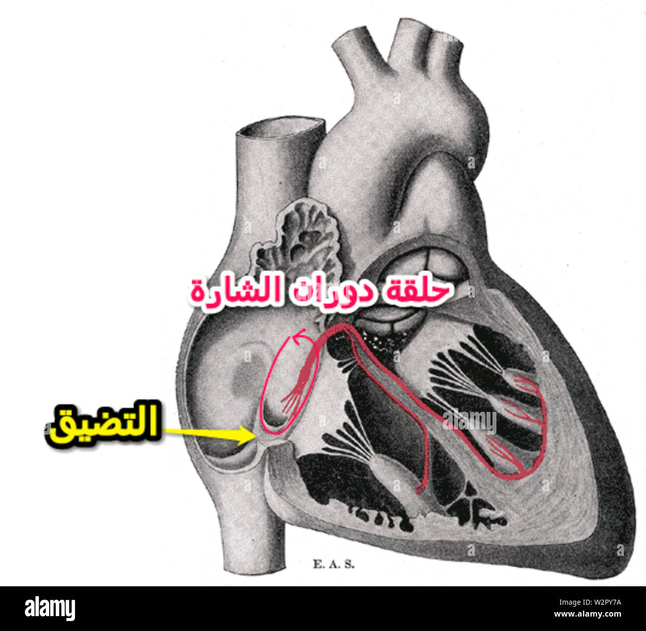 Atrial Flutter Ring Stock Photo - Alamy