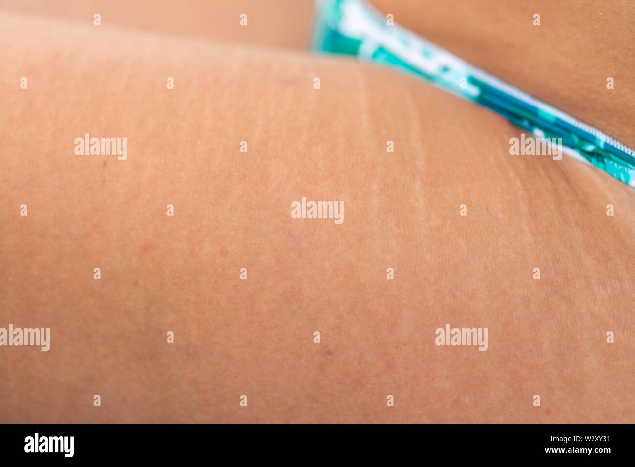 Stretch Mark High Resolution Stock Photography and Images - Alamy
