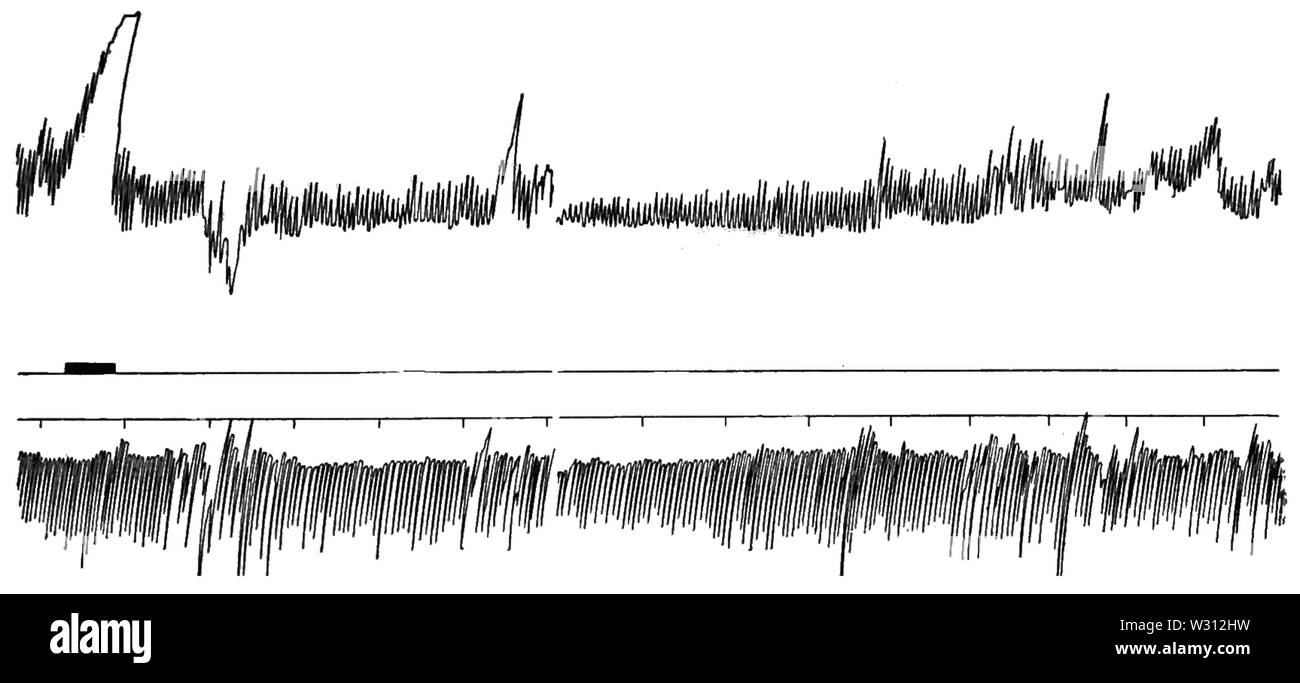 Pneumograph High Resolution Stock Photography and Images - Alamy