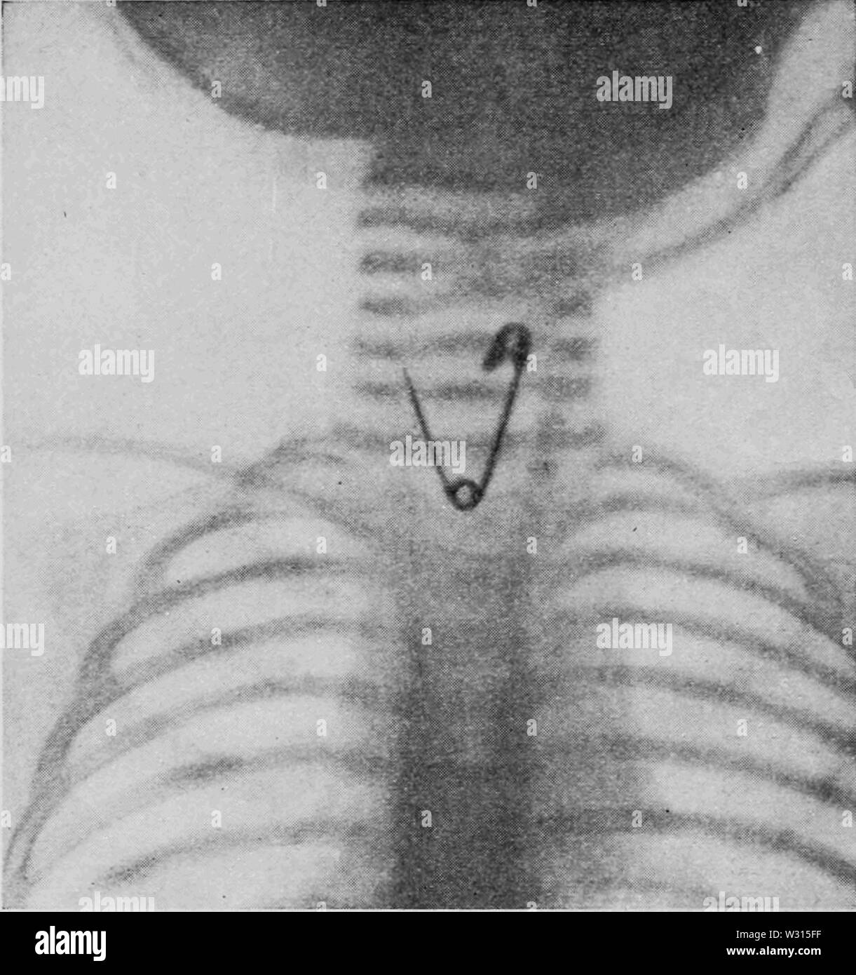 PSM V88 D082 X ray of a pin stuck in the throat Stock Photo - Alamy