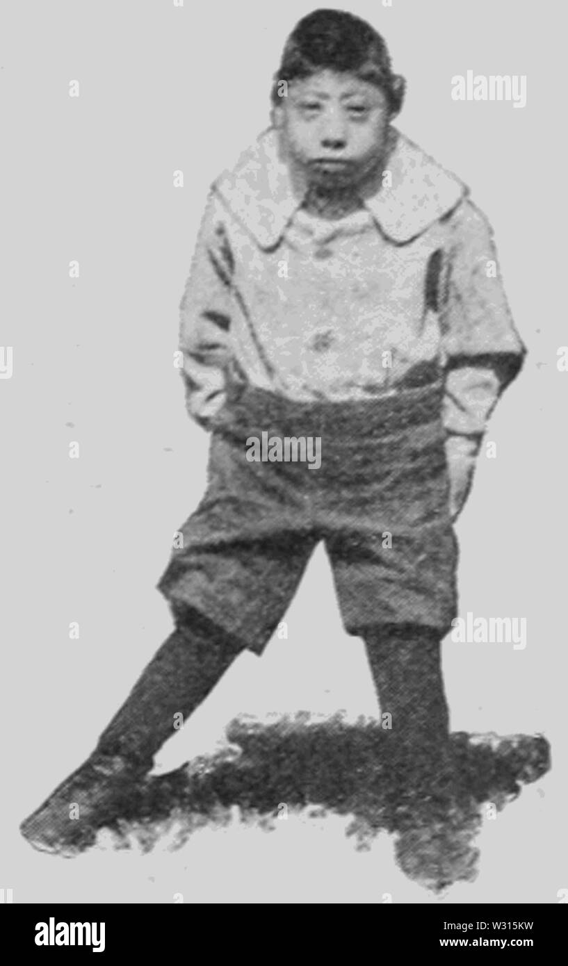 Microcephaly Pinhead