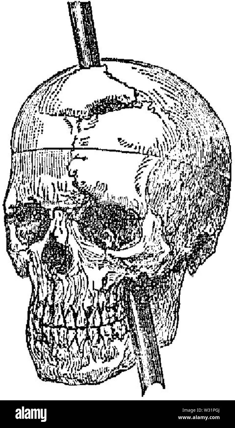 Recovery from the passage of an iron bar through the head figure 02 ...