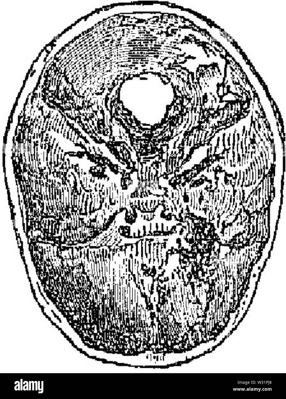 Recovery from the passage of an iron bar through the head figure 03 ...