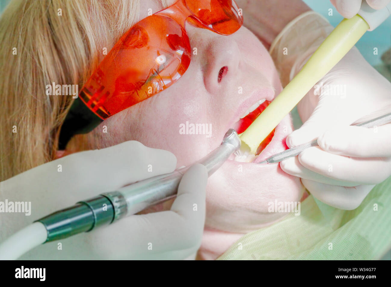 The most common method to remove the tooth decay in and around the ...