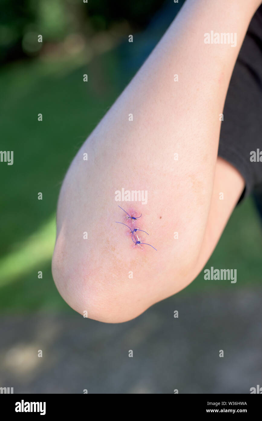 Wound care child hi-res stock photography and images - Alamy