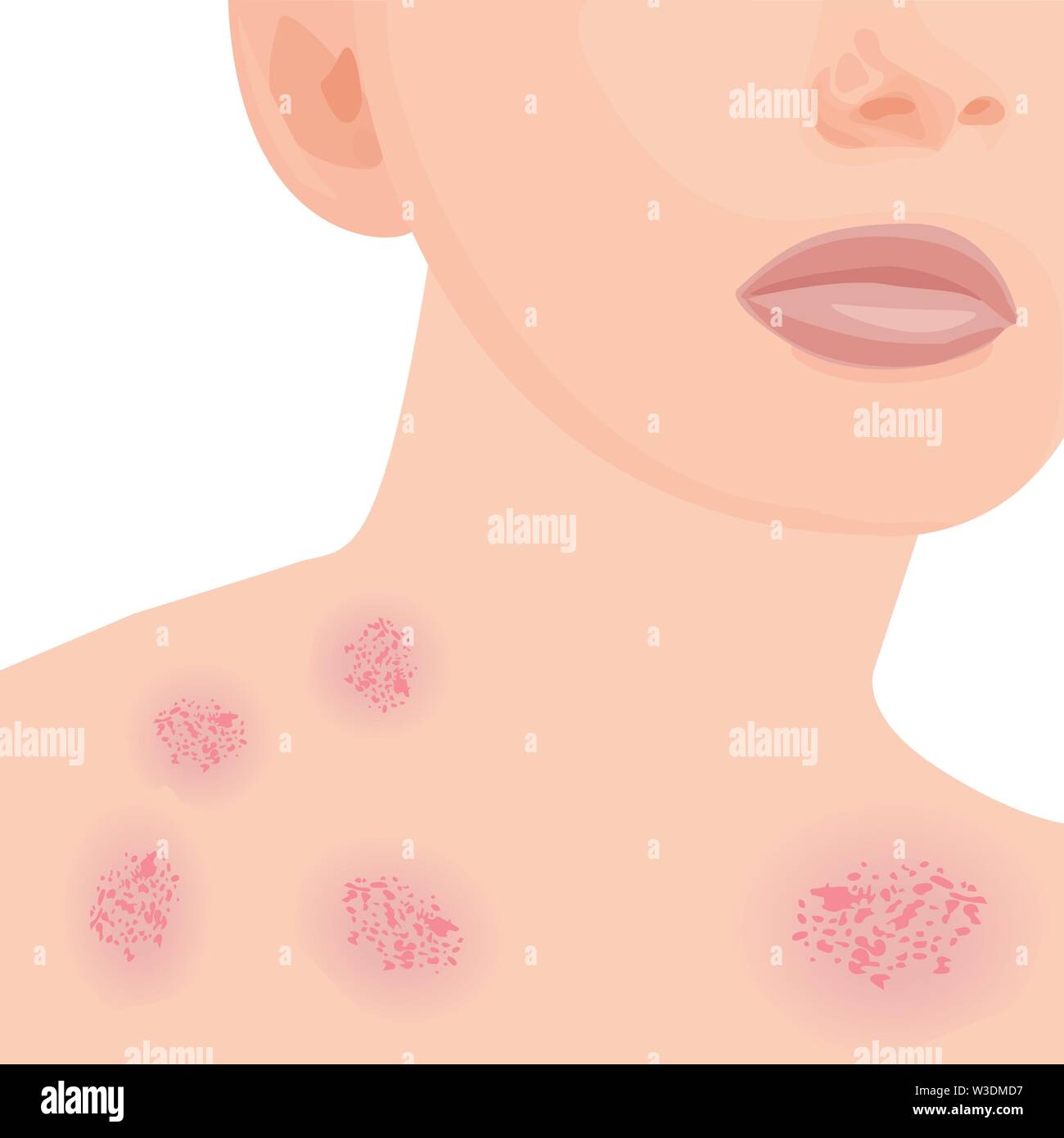 Itchy Skin Illustration High Resolution Stock Photography and Images ...