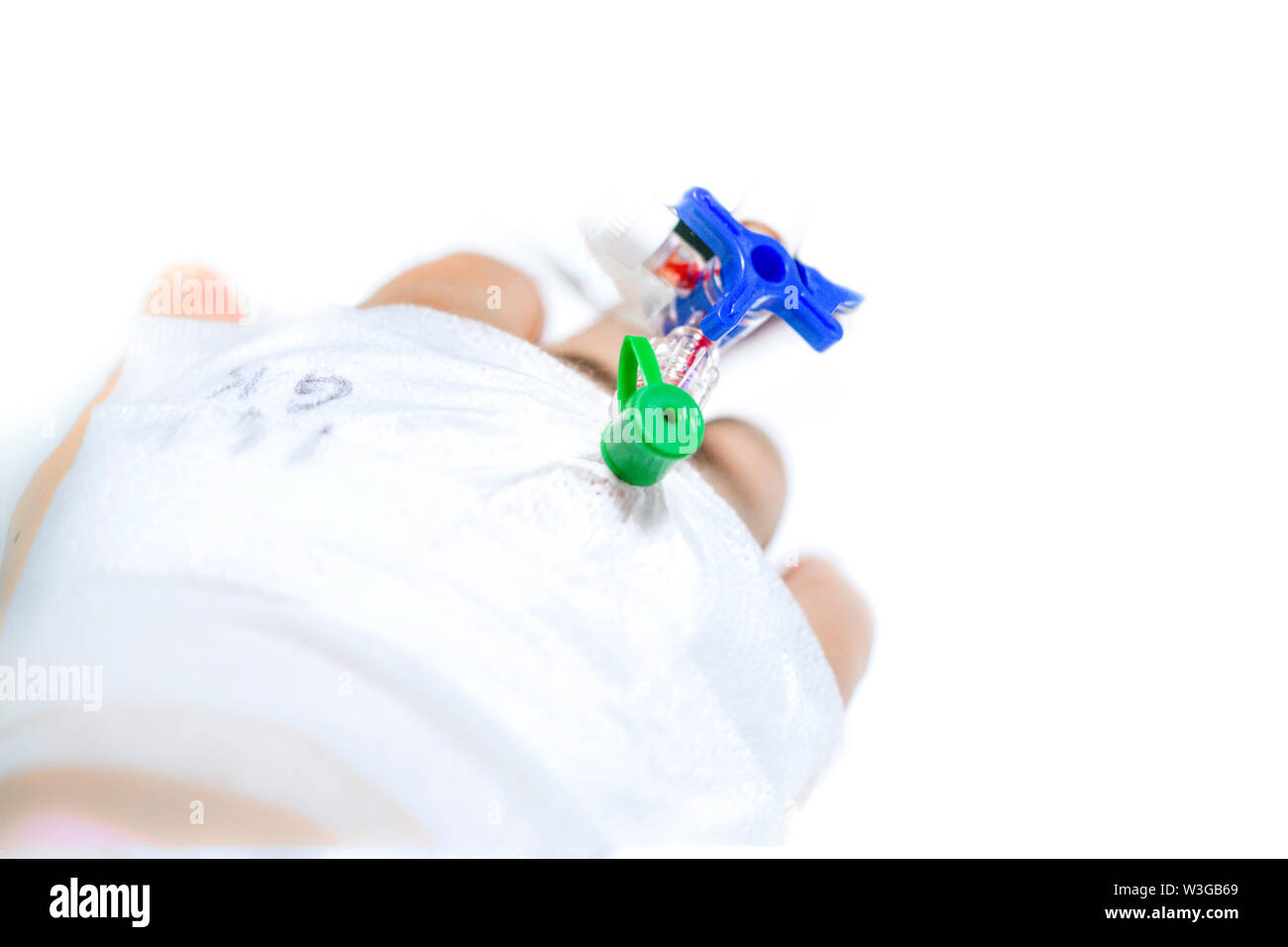 Temporary vascular access hi-res stock photography and images - Alamy