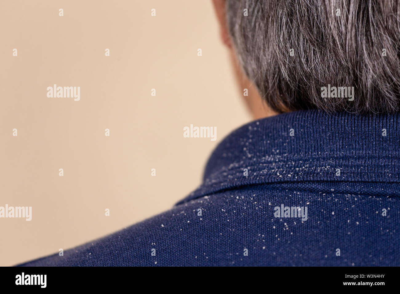 Close-up view of a man who has a lot of dandruff from his hair on his ...