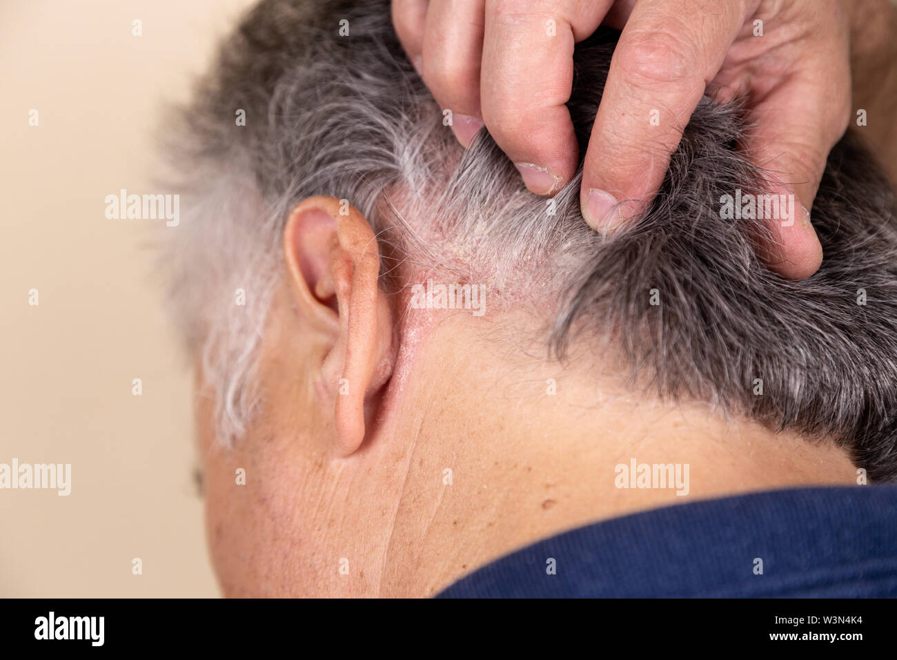 Psoriasis Vulgaris, psoriatic skin disease in hair, skin patches are ...