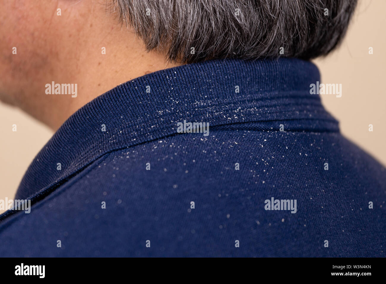 Close-up view of a man who has a lot of dandruff from his hair on his ...