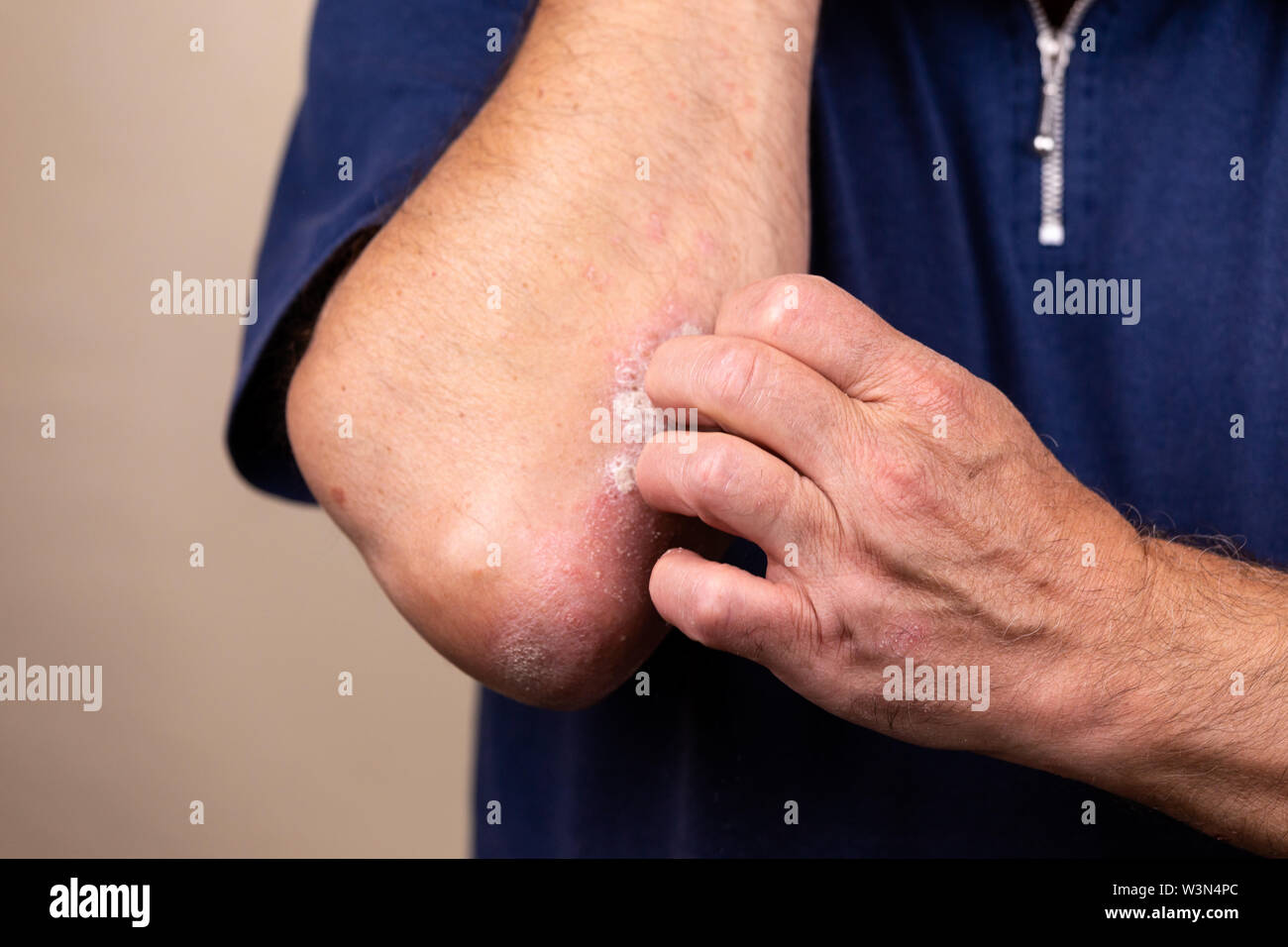 Close up dermatitis on skin, ill allergic rash dermatitis eczema of patient , atopic dermatitis ...
