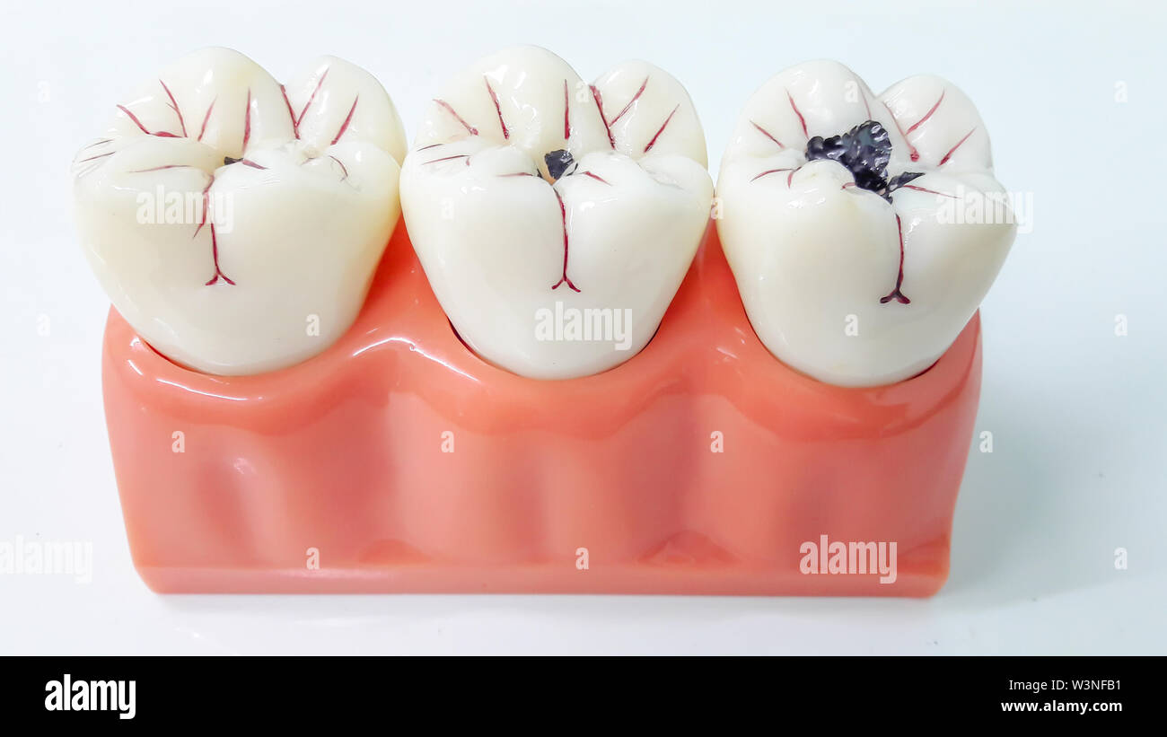 dental model,teeth model on white background Stock Photo - Alamy