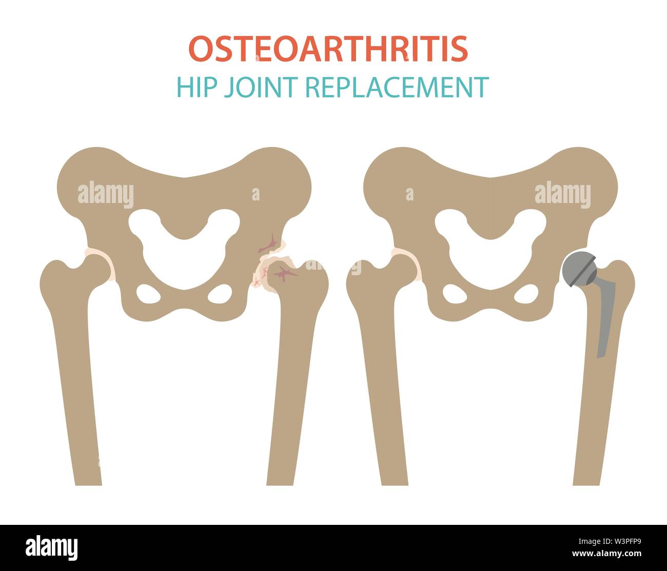Artificial knee replacement Cut Out Stock Images & Pictures - Alamy