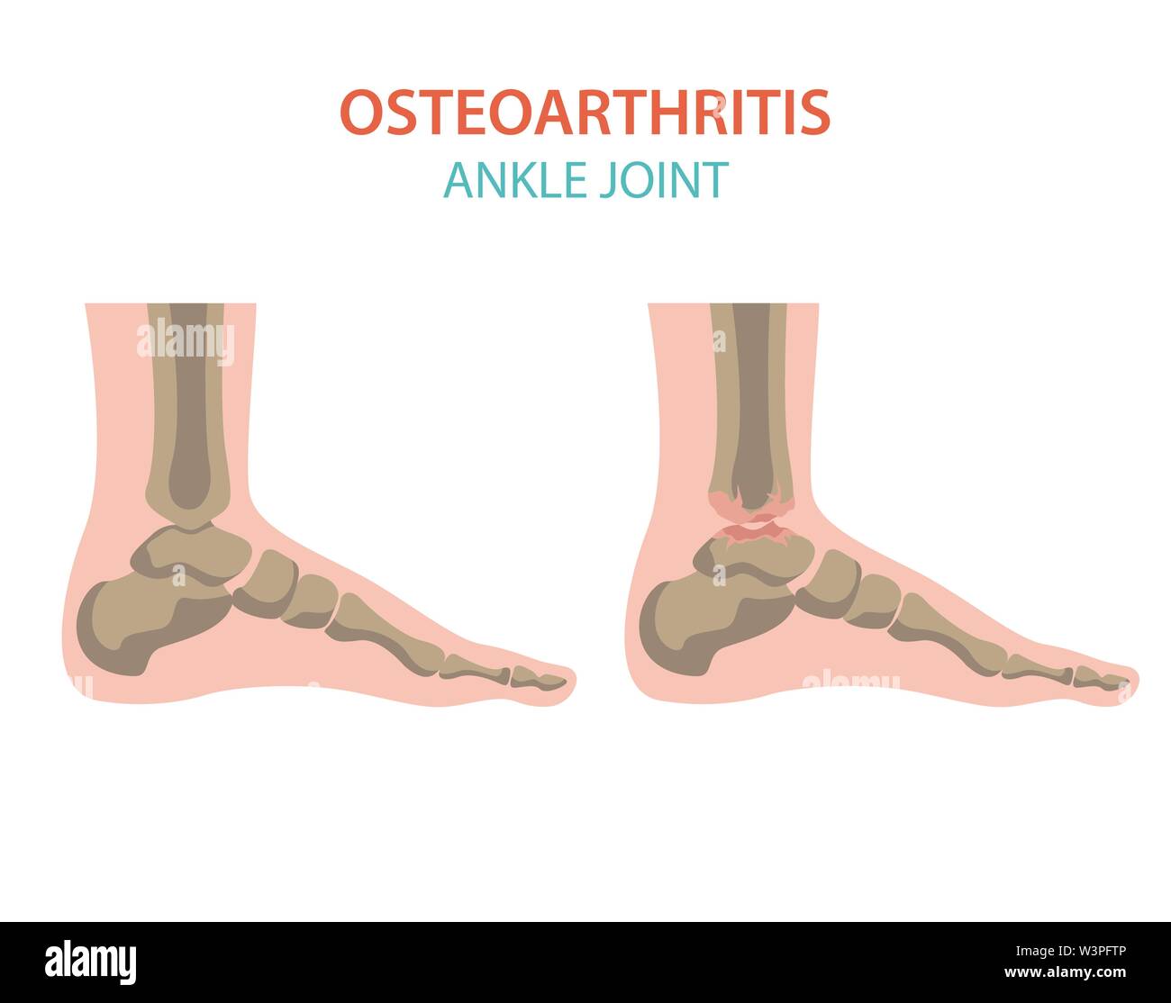Knee replacement infographic hi-res stock photography and images - Alamy