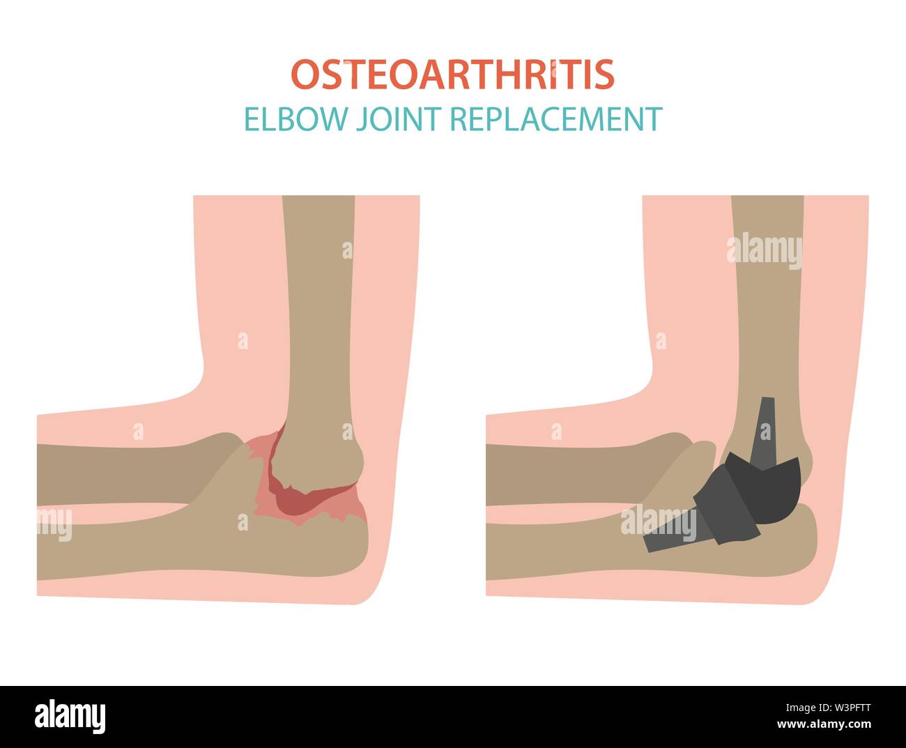 Arthritis, osteoarthritis medical infographic design. Joint replacement ...