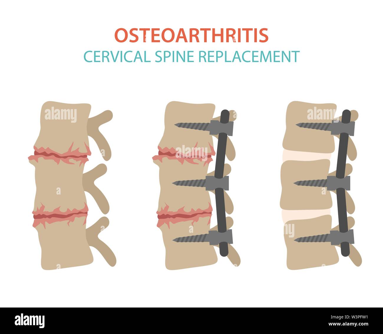 Arthritis, osteoarthritis medical infographic design. Joint replacement ...