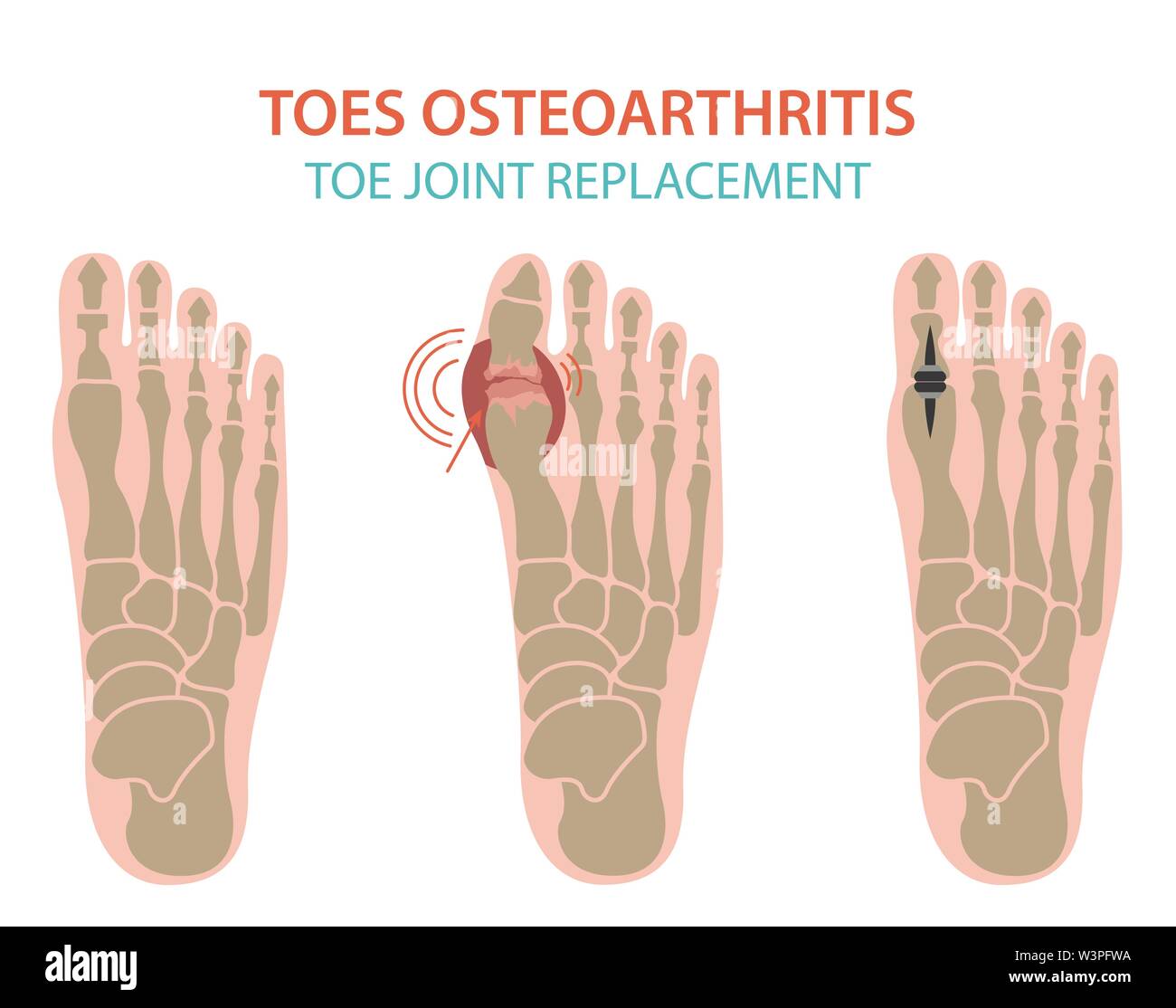 Arthritis, osteoarthritis medical infographic design. Joint replacement ...