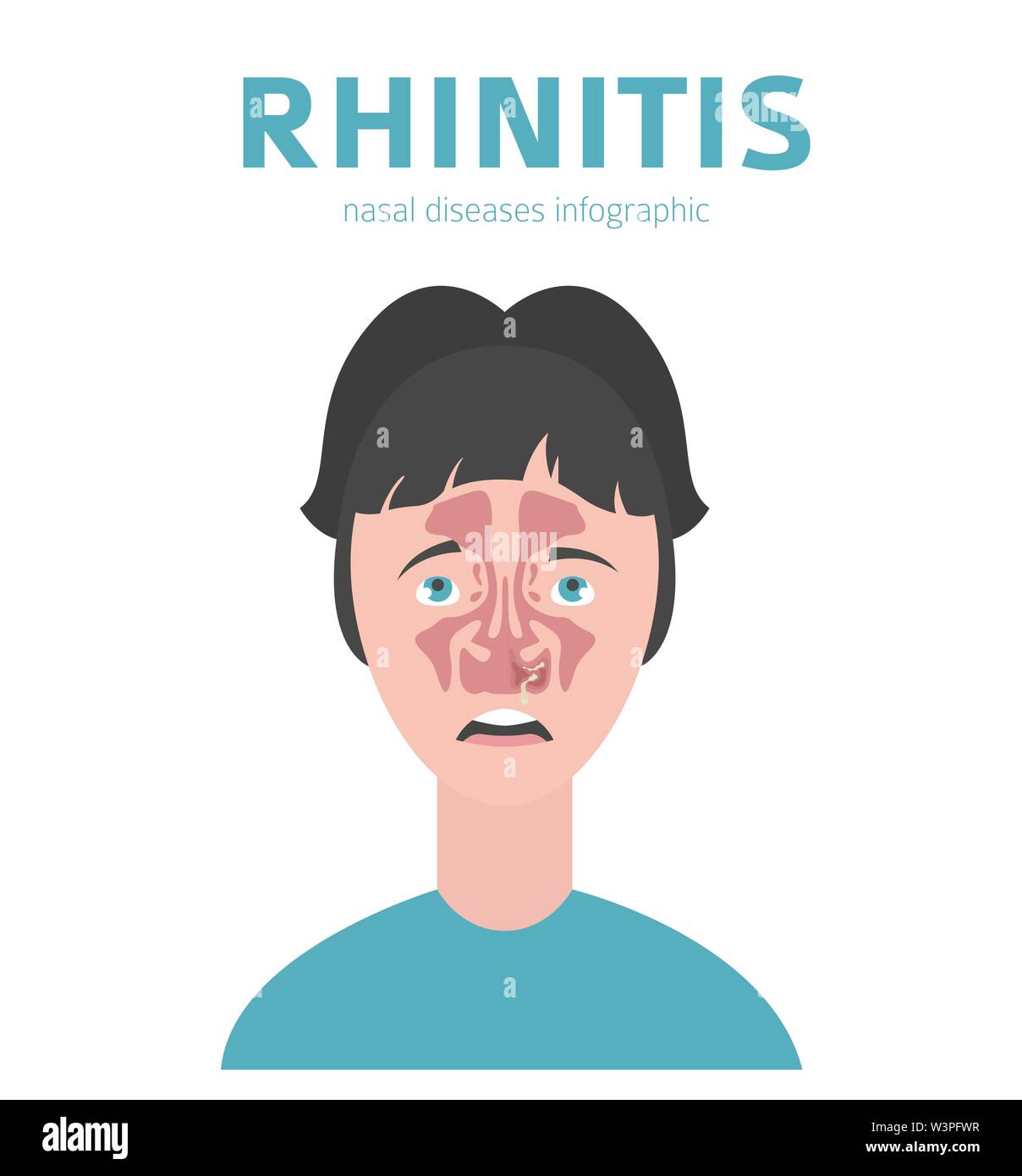 Nasal diseases. Rhinitis symptoms, treatment icon set. Medical ...