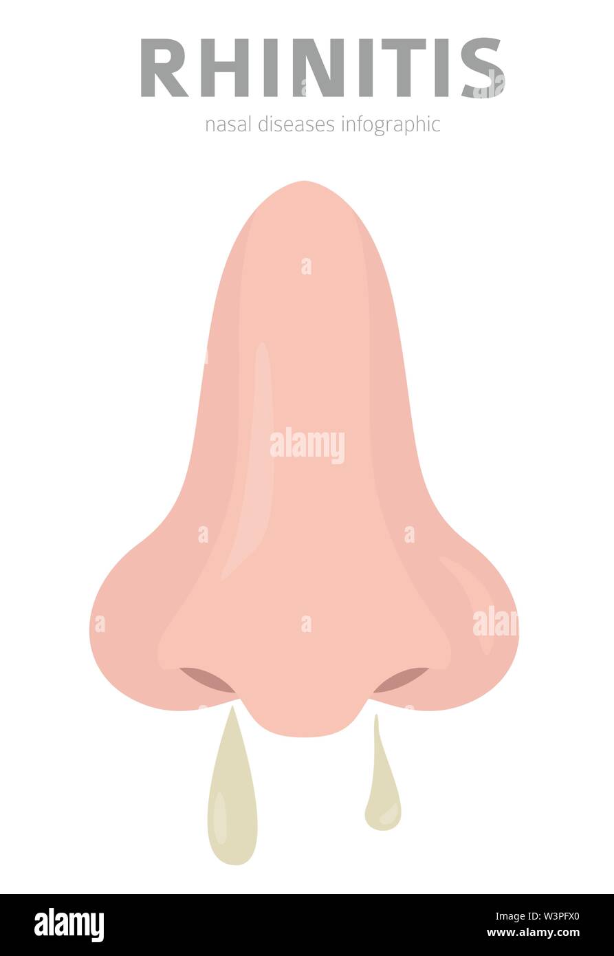 Nasal diseases. Rhinitis symptoms, treatment icon set. Medical ...