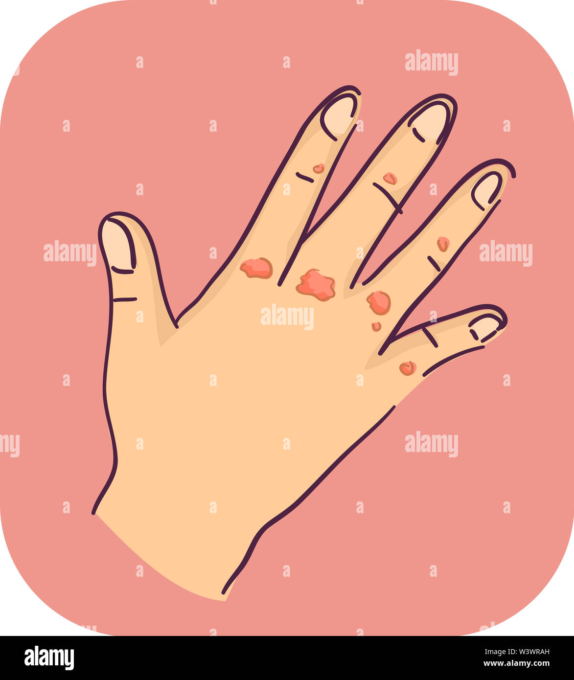 Illustration of Scarred Hands Stock Photo - Alamy