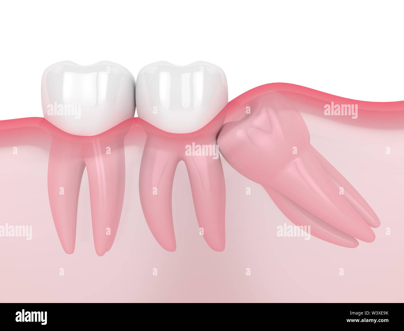 3d render of jaw with wisdom mesial impaction over white background ...