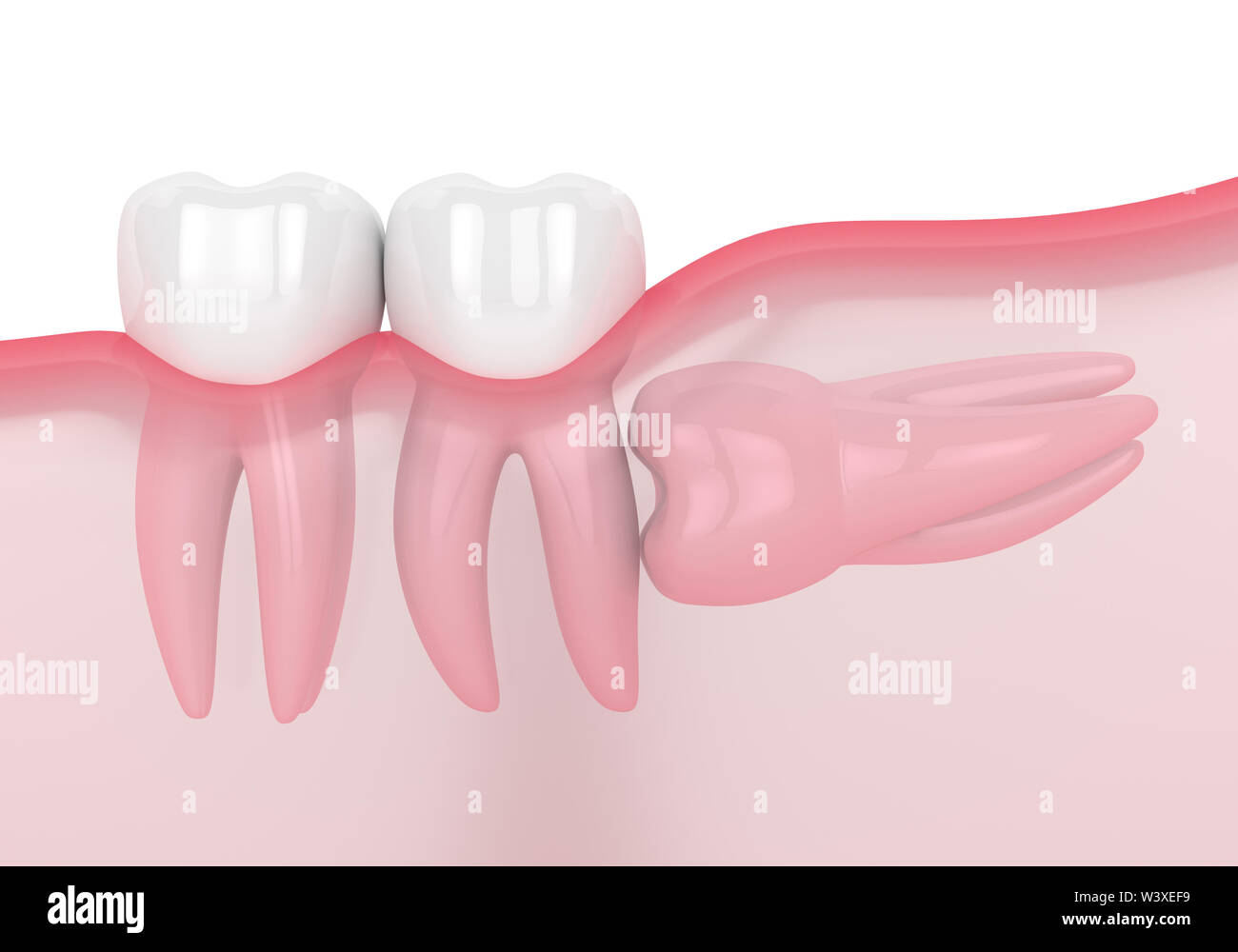 3d render of jaw with wisdom horizontal impaction over white background ...