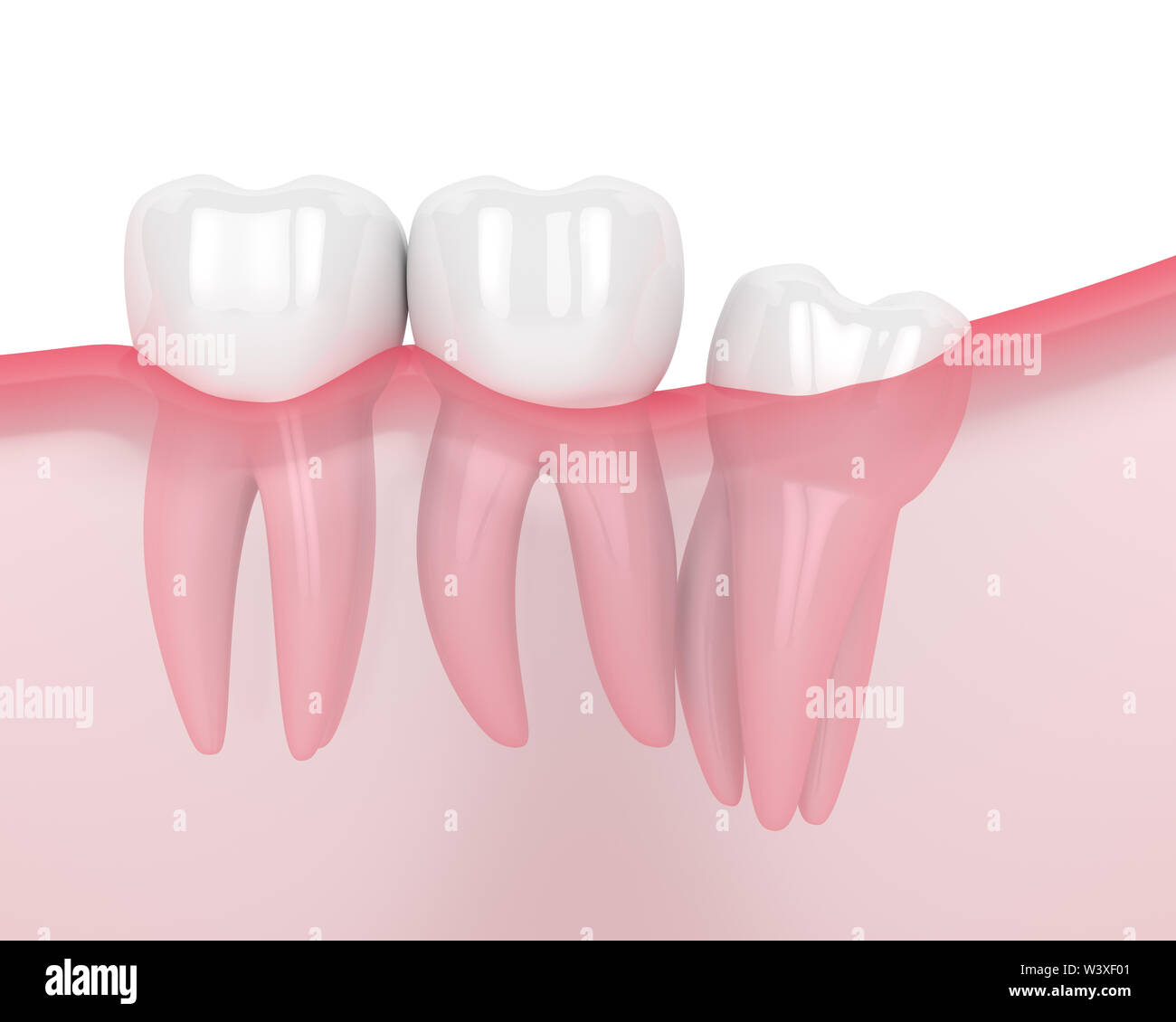 3d render of jaw with wisdom distal impaction over white background ...