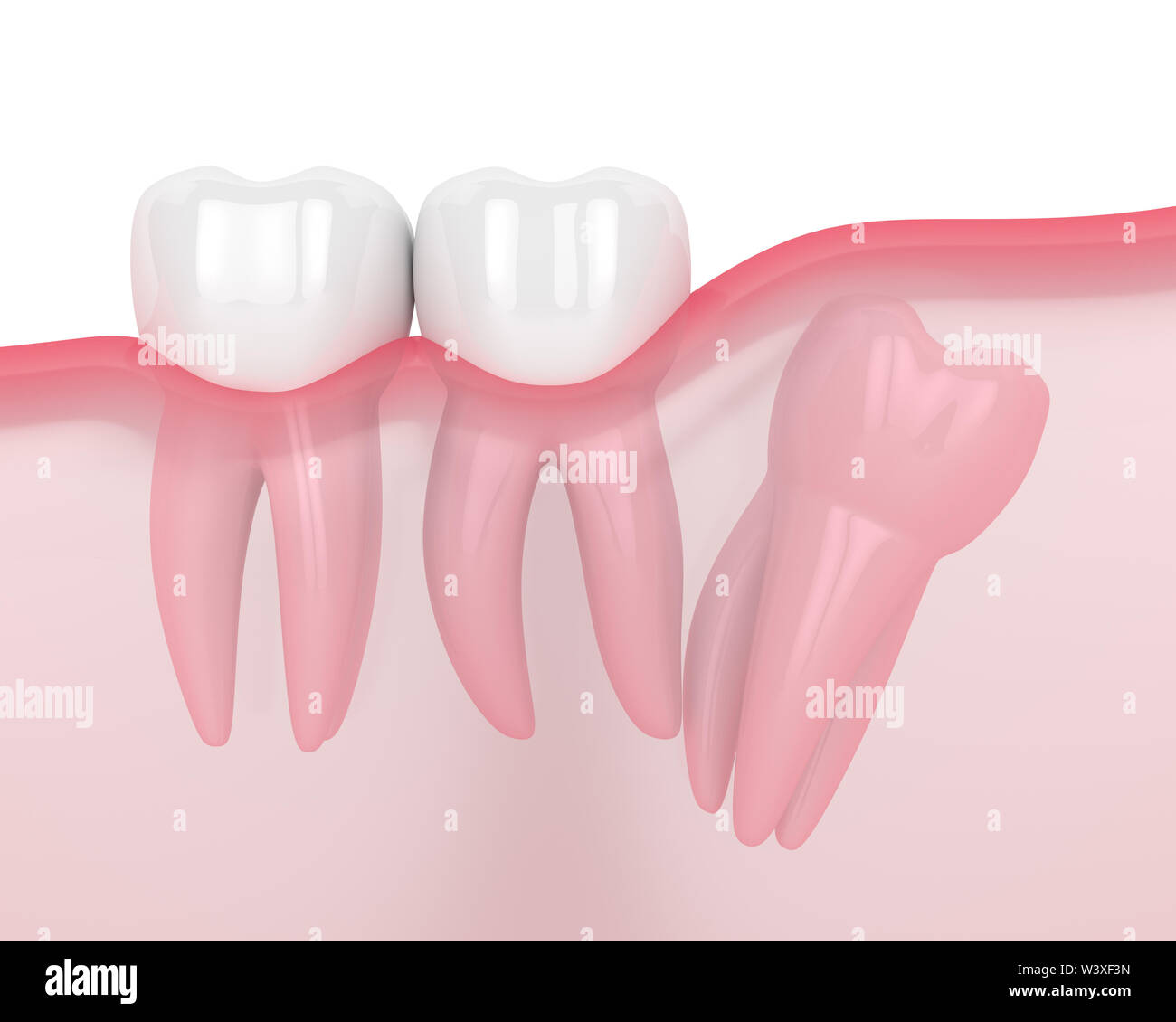 3d render of jaw with wisdom distal impaction over white background ...
