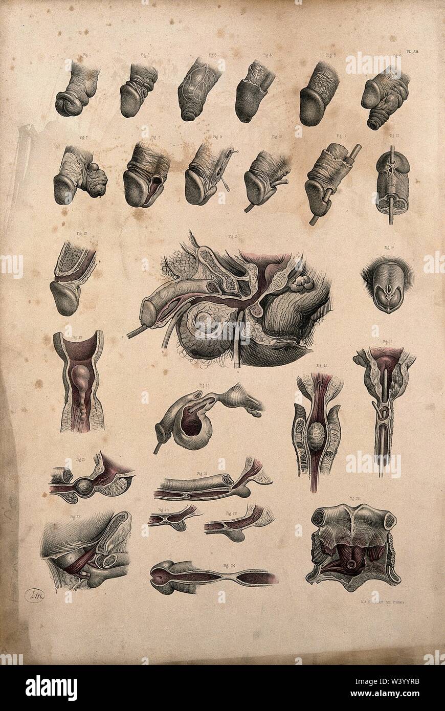 Urethra disease hi-res stock photography and images - Alamy