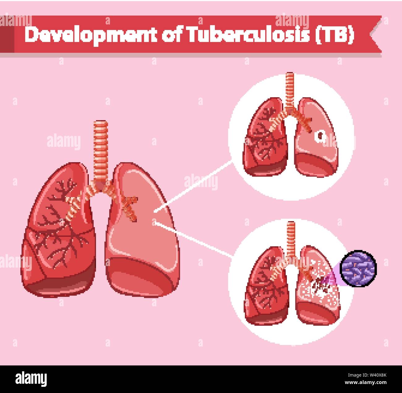 Scientific medical illustration of tuberculosis illustration Stock ...