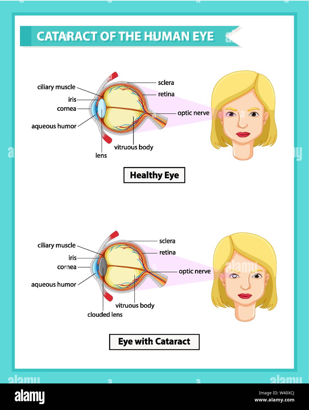 Scientific medical illustration of cataract of human eye illustration ...