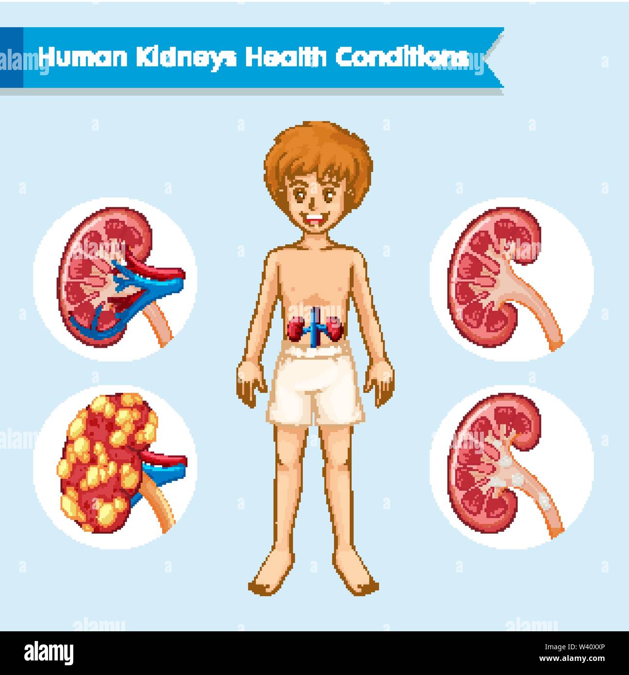 Scientific medical illustration of kidney disease illustration Stock ...
